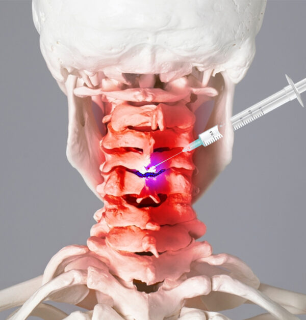 Midline Epidural Steroid Injection Cervical Thoracic Interlaminal ESI ...