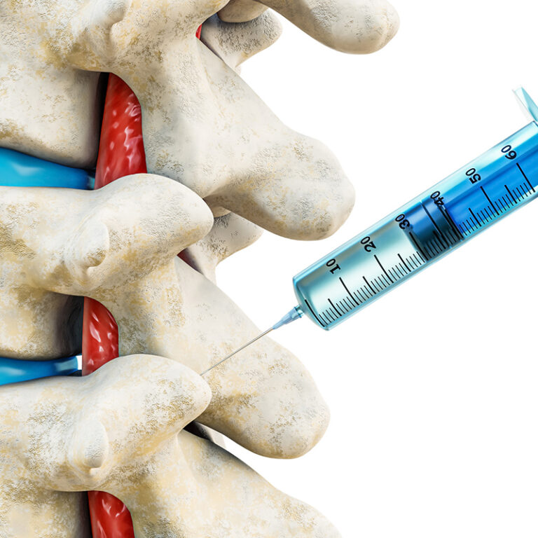 Midline Epidural Steroid Injection Lumbar Sacral Interlaminal ESI – Genesis